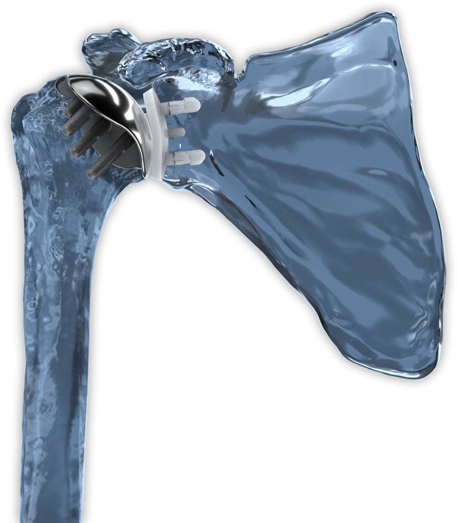 Catalyst CSR™ Total Shoulder System - Catalyst OrthoScience