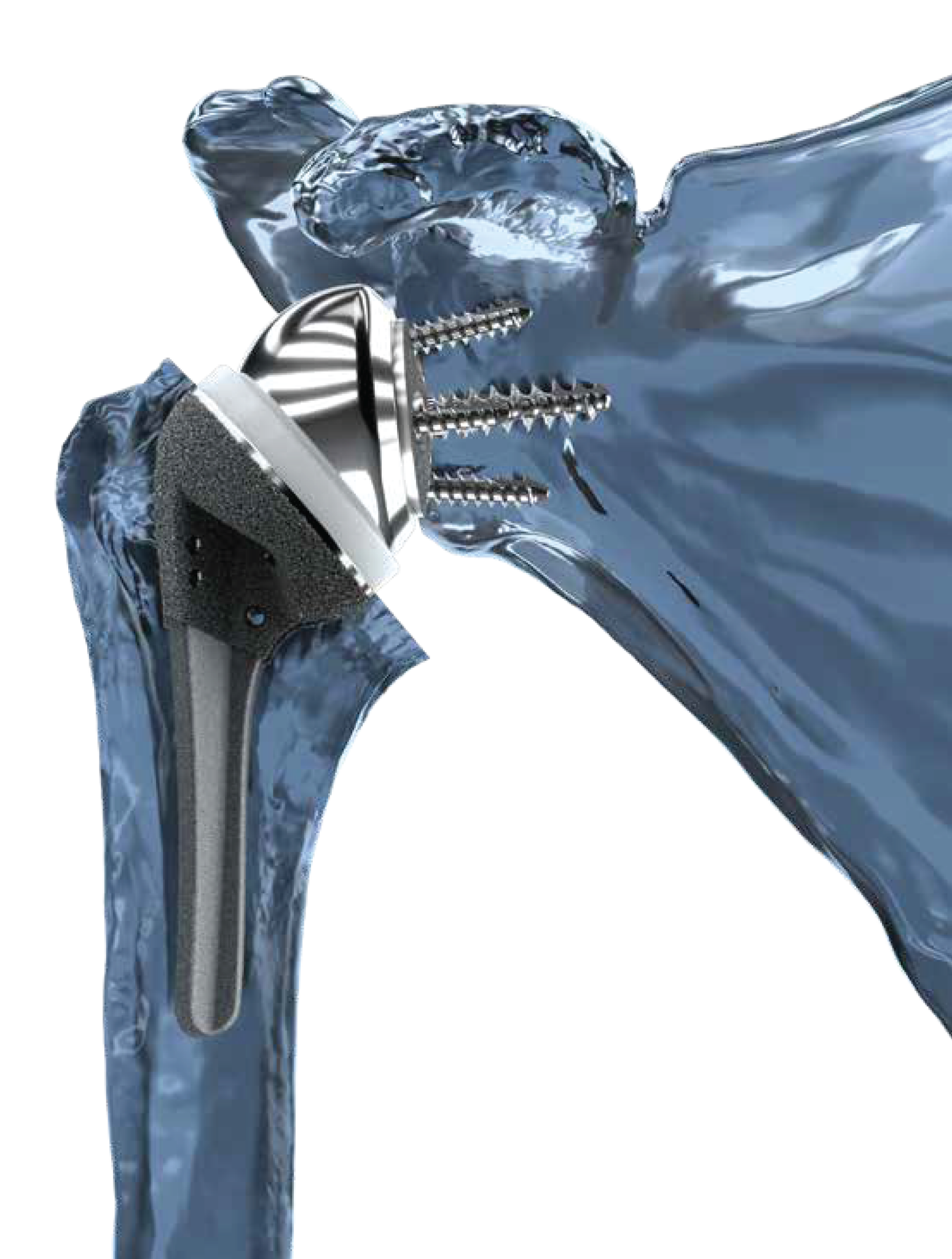 Catalyst Reverse Shoulder System - Catalyst OrthoScience