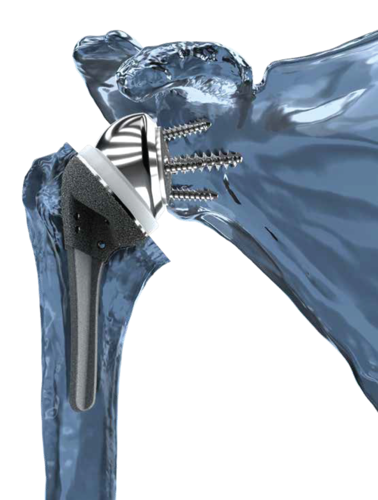 Catalyst Reverse Shoulder System - Catalyst OrthoScience