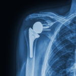 Shoulder Replacement Patients - Catalyst OrthoScience