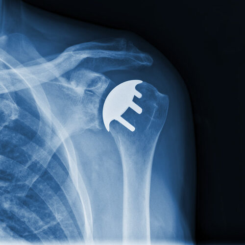 Shoulder Replacement Patients - Catalyst OrthoScience