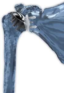 Catalyst CSR™ Total Shoulder System - Catalyst OrthoScience