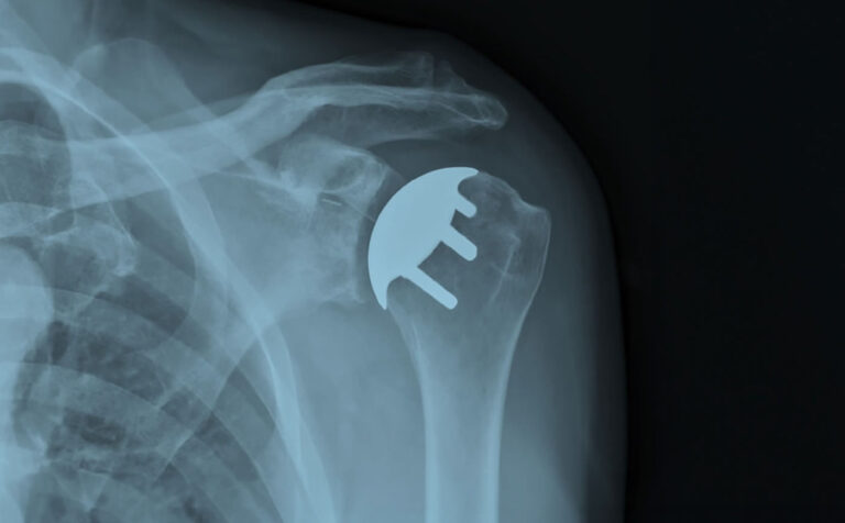 Healthcare Professionals - Catalyst OrthoScience