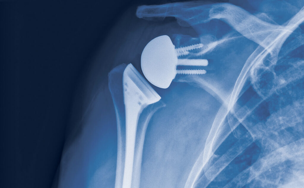 Healthcare Professionals - Catalyst OrthoScience